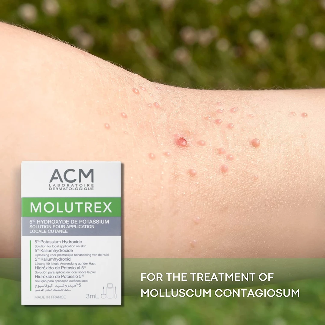 ACM MOLUTREX 5% Kapi Kalijum Hidroksida 3 mL, | eApoteka