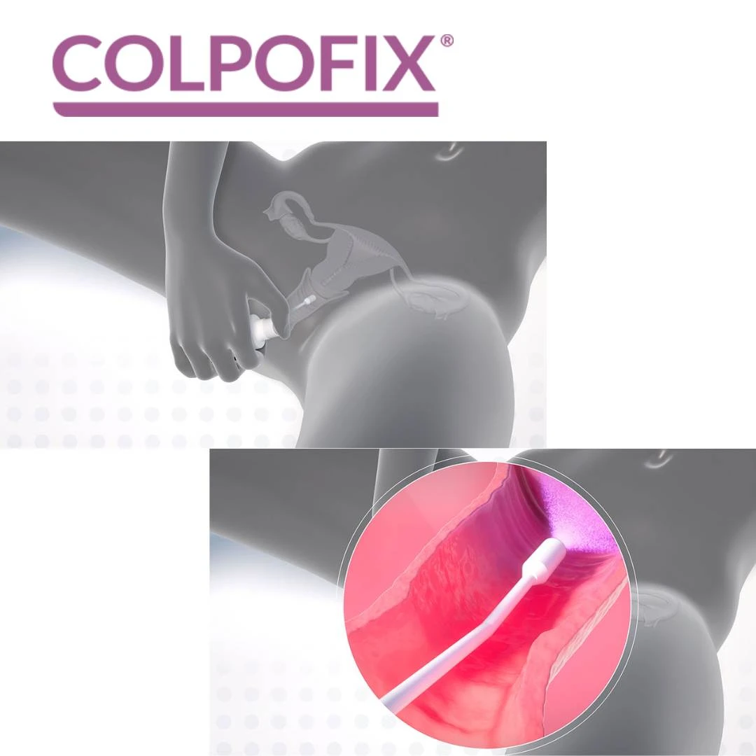 COLPOFIX® Vaginalni Sprej Gel 20 mL 10 Aplikacija, | eApoteka