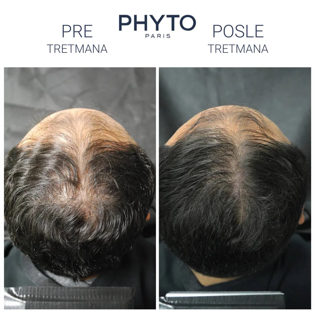 PHYTOCYANE MEN Tretman Protiv Opadanja Kose za Muškarce 12x3,5 mL ...