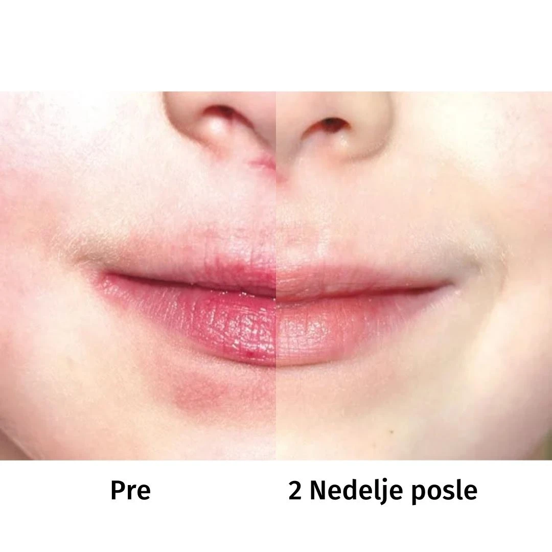 Eucerin® Acute Balsam za Ekstra Suve Usne 10 mL, | eApoteka