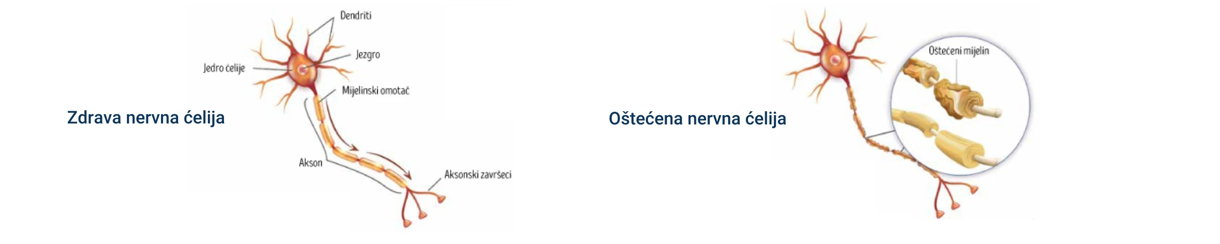 Polineuropatija simptomi i lekovi | eApoteka